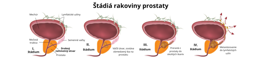 Rakovina prostaty - Indonal.sk | Indonal®